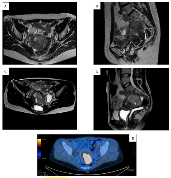 Endometrial Stromal Sarcoma: An Update