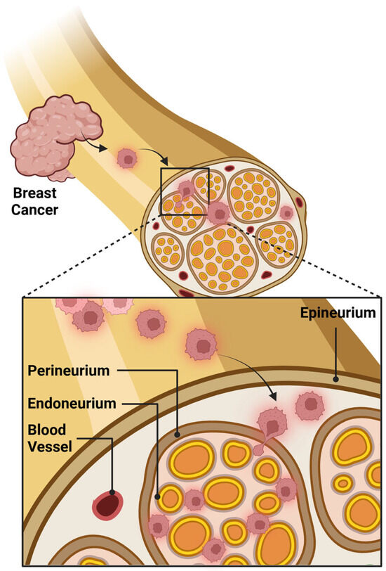 Perineural Invasion in Breast Cancer: A Comprehensive Review