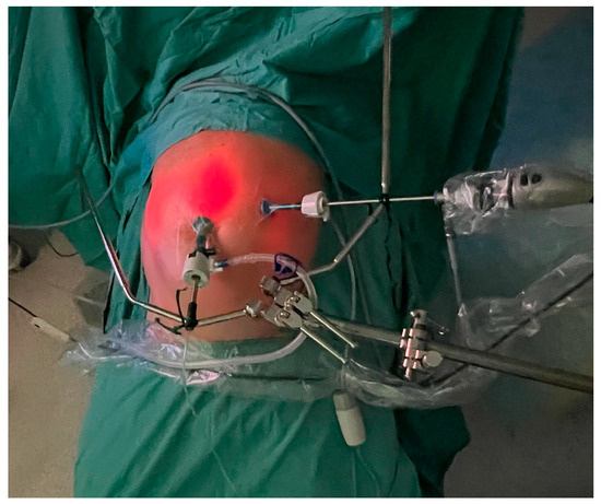 Pressurized Intra-Peritoneal Aerosol Chemotherapy (PIPAC) for ...