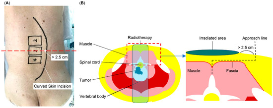 Risk Factors for Wound Dehiscence After Spinal Metastasis Surgery and a ...