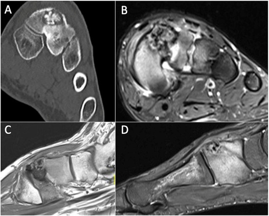 Beyond the Signal: Imaging Insights and Diagnostic Relevance of Bone ...