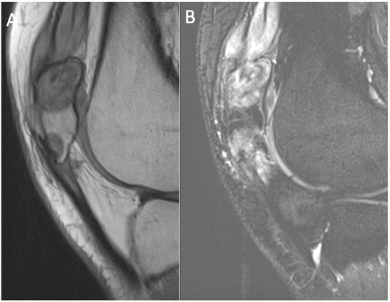 Beyond the Signal: Imaging Insights and Diagnostic Relevance of Bone ...
