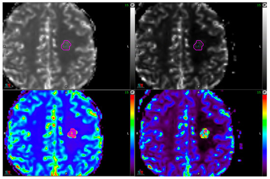 Improving Diagnostic Robustness of Perfusion MRI in Brain Metastases: A ...