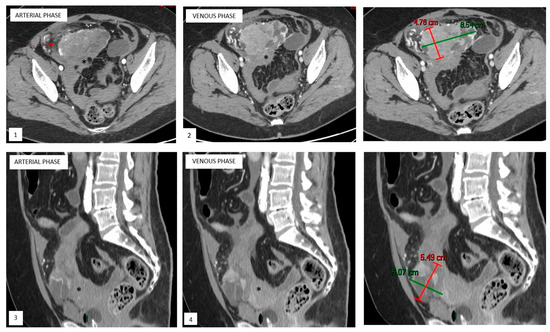 Malignant Perivascular Epithelioid Cell Tumor (PEComa) of the Uterus: A ...