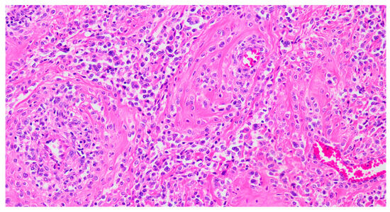 Malignant Perivascular Epithelioid Cell Tumor (PEComa) of the Uterus: A ...