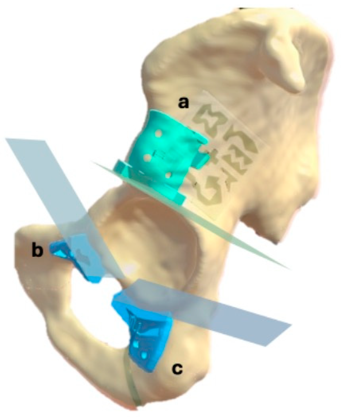 Augmented Reality-Assisted Placement of Surgical Guides and Osteotomy ...