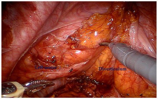 Partial Cystectomy for Muscle-Invasive Bladder Cancer