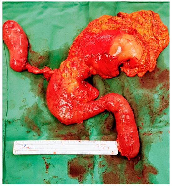 A Review of Quality of Life Experienced by Patients Following Surgery ...