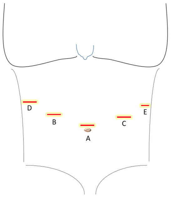 Laparoscopic Versus Robotic Completely Intracorporeal Jejunal Pouch ...