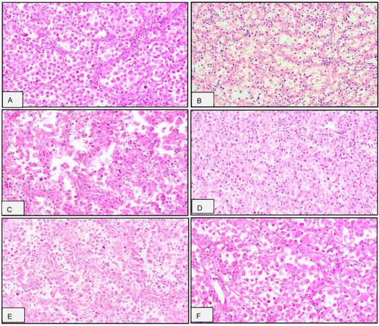 Molecular and Clinicopathological Profiling of Clear Cell Renal Cell ...