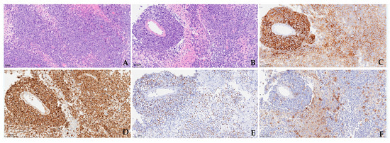 The Landscape of Primary Central Nervous System Lymphoma (PCNSL ...