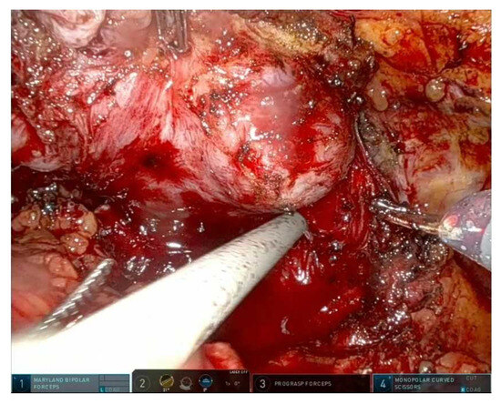 The Role of Robot-Assisted Radical Prostatectomy in the Management of ...