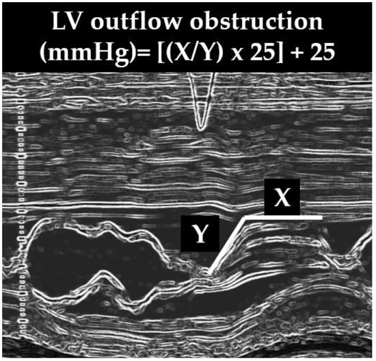 Diagnosis and Treatment of Obstructive Hypertrophic Cardiomyopathy