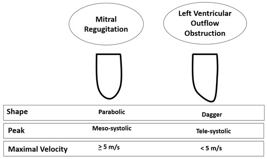 Diagnosis and Treatment of Obstructive Hypertrophic Cardiomyopathy