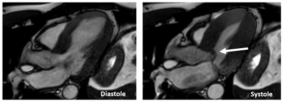 Diagnosis and Treatment of Obstructive Hypertrophic Cardiomyopathy