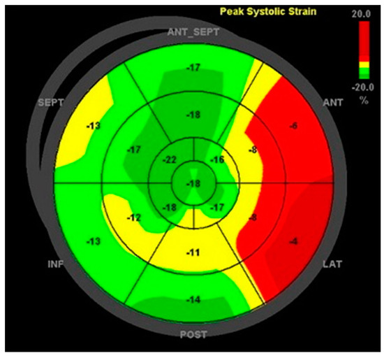 Sudden Cardiac Death in Biventricular Arrhythmogenic Cardiomyopathy: A ...