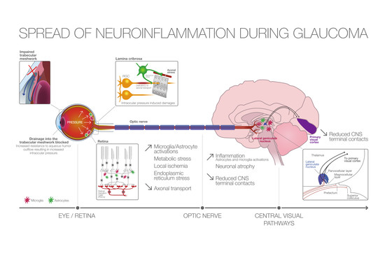 Cells | Free Full-Text | Glaucoma: A Degenerative Optic Neuropathy ...