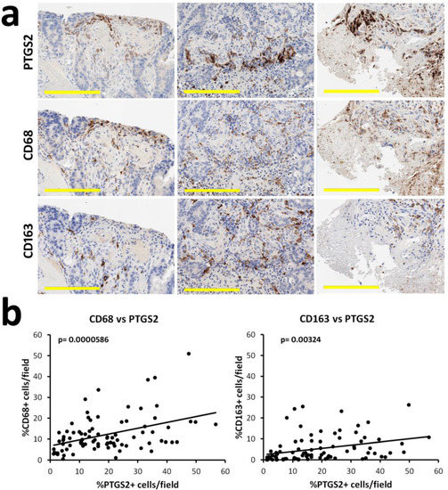 Evaluation of Glycosylated PTGS2 in Colorectal Cancer for NSAIDS-Based ...