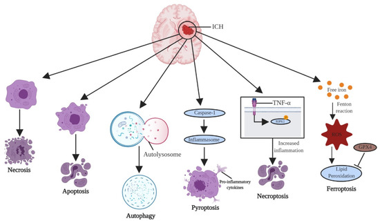 A Role for Endoplasmic Reticulum Stress in Intracerebral Hemorrhage