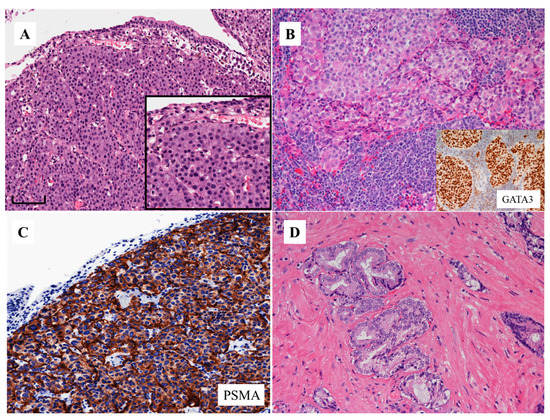 Morphologic, Molecular and Clinical Features of Aggressive Variant ...