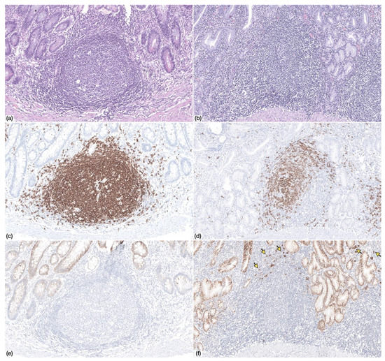 The Dysfunctional Immune System in Common Variable Immunodeficiency ...