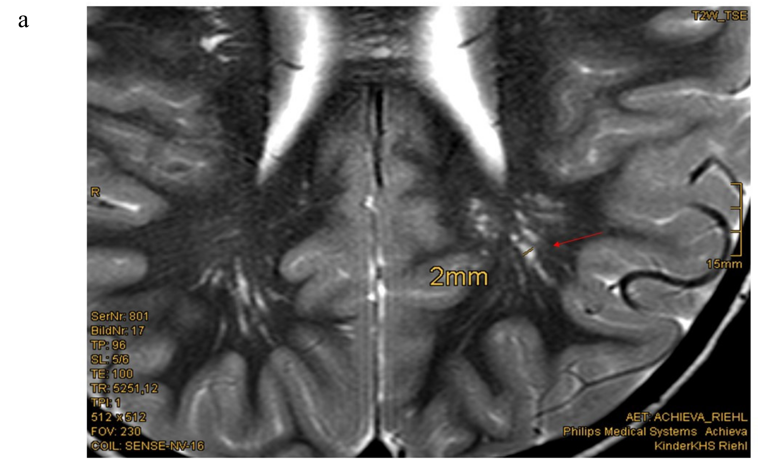 Macrocephaly Mri