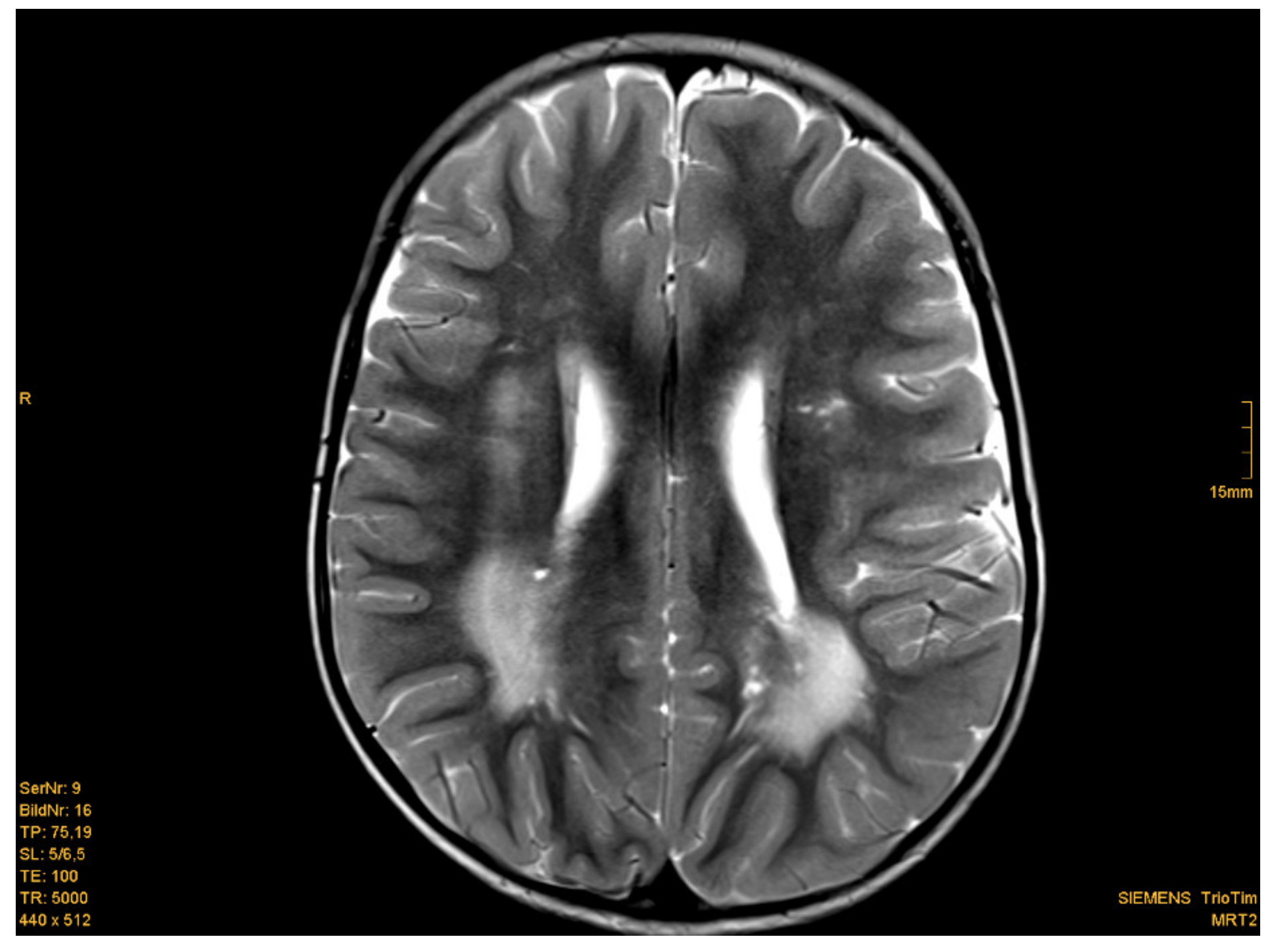 Cerebral MRI and Clinical Findings in Children with PTEN Hamartoma ...