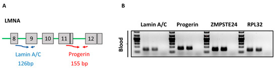 ZMPSTE24 Is Associated with Elevated Inflammation and Progerin mRNA