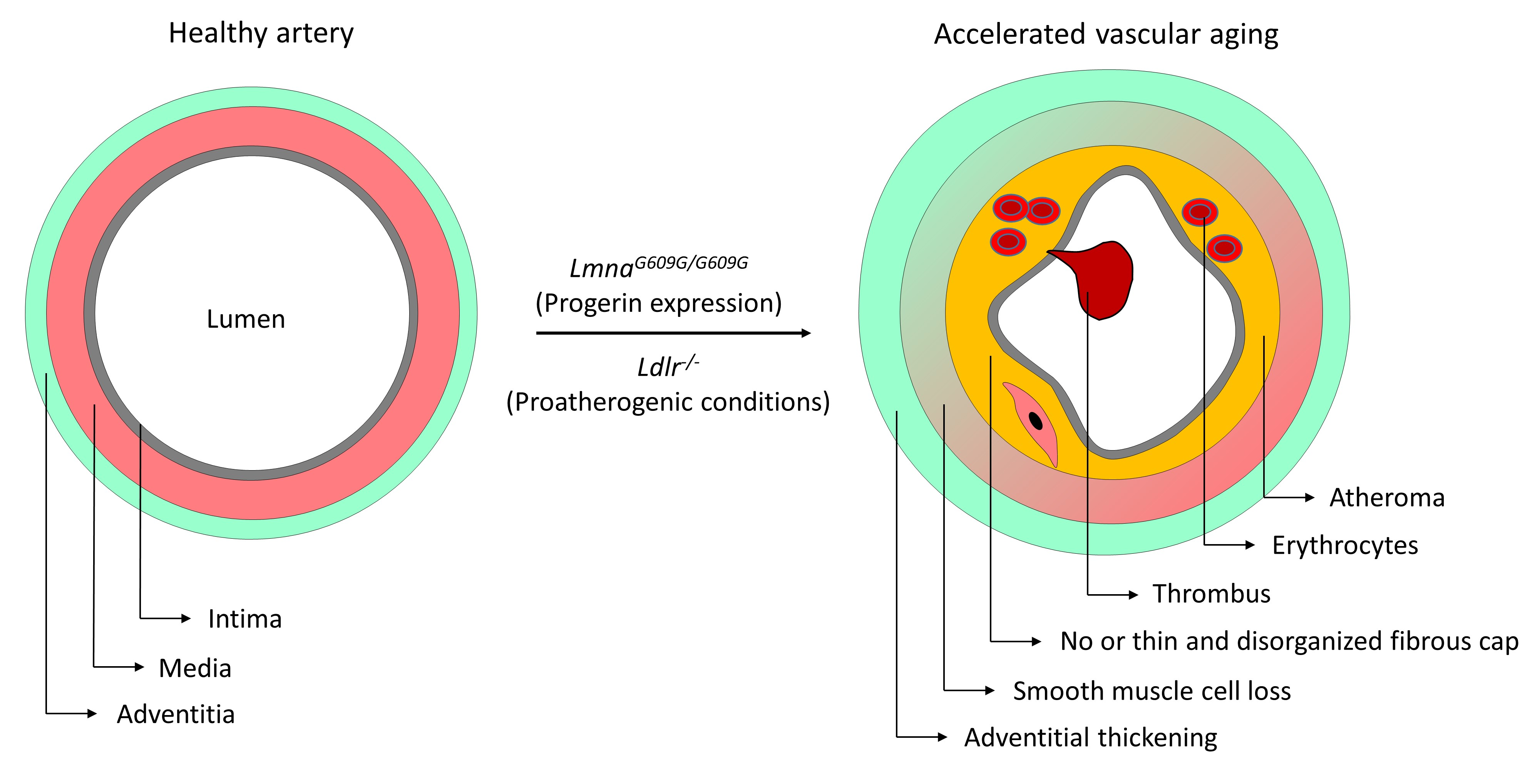 Cells | Free Full-Text | Premature Vascular Aging with Features of ...