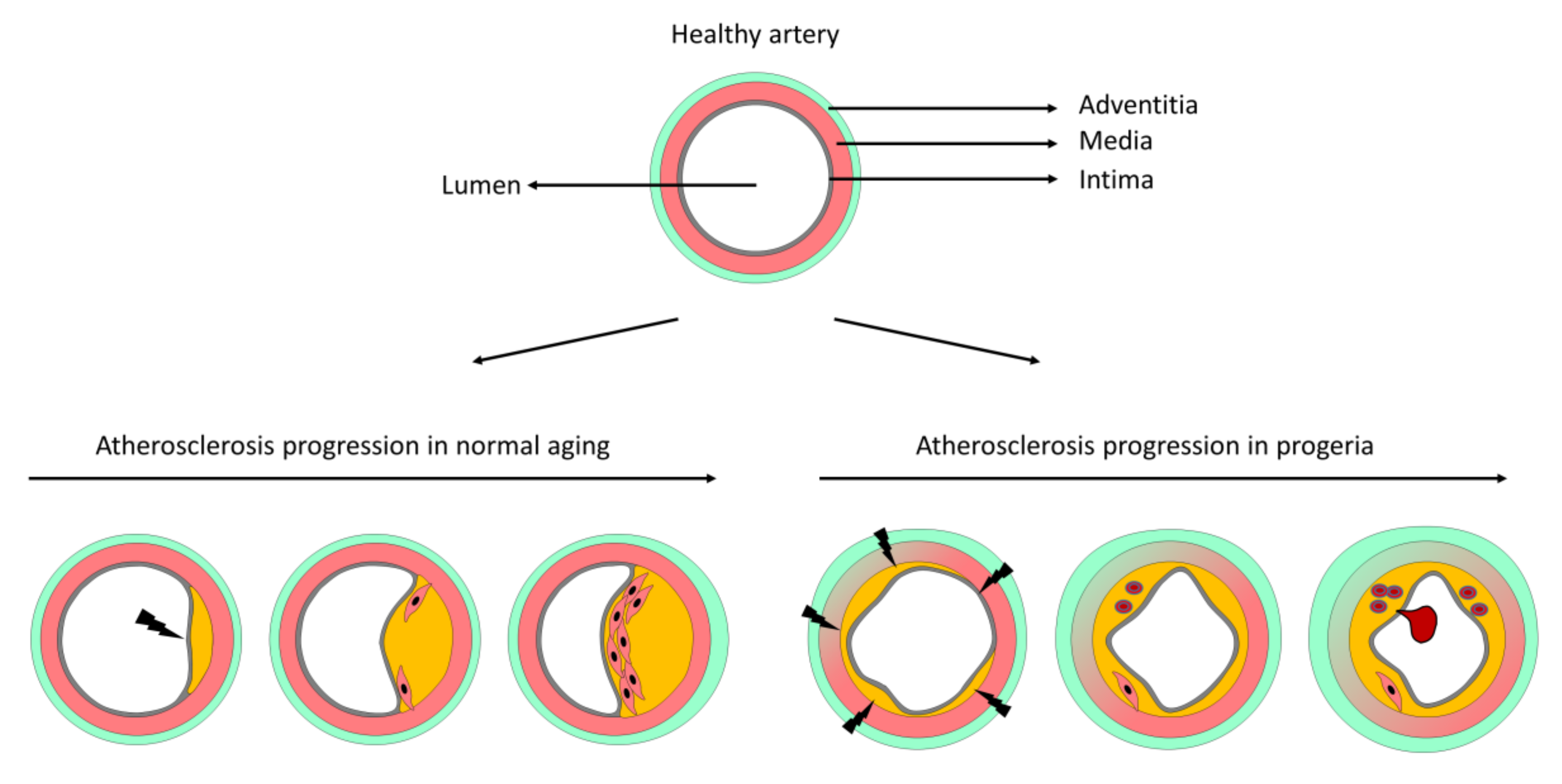Progeria Cell Diagram