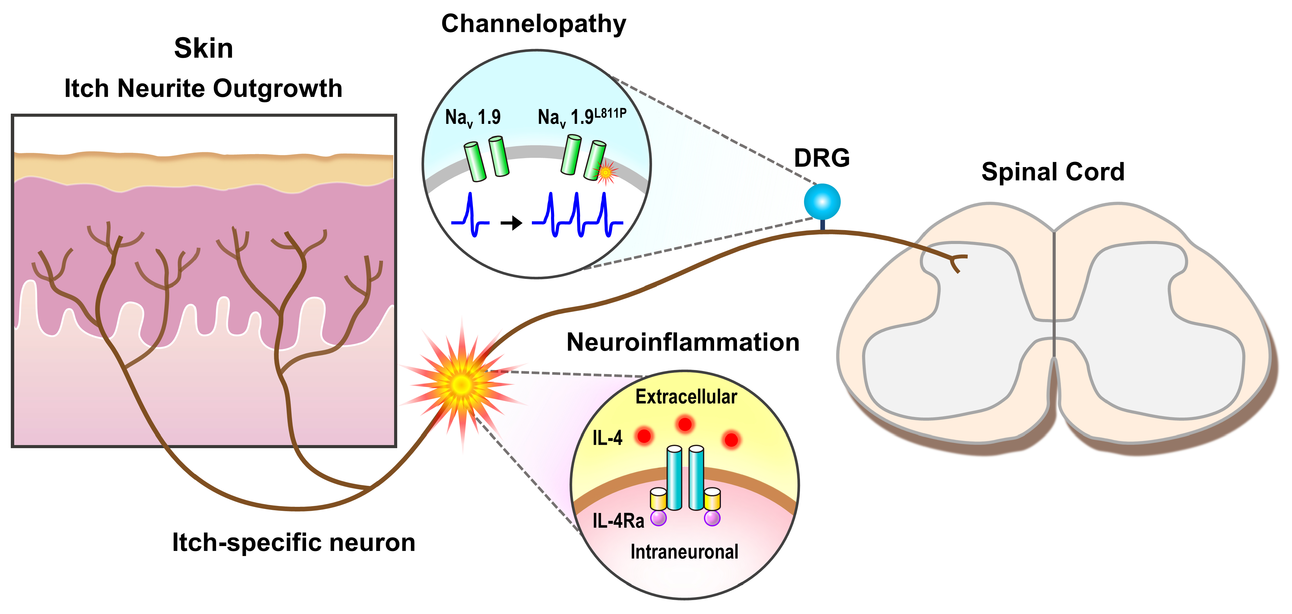 Neuropathic Itch