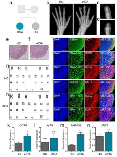 Characterization of Early-Onset Finger Osteoarthritis-Like Condition Using Patient-Derived ...