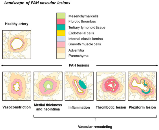 Iron Deficiency in Pulmonary Arterial Hypertension: A Deep Dive into ...