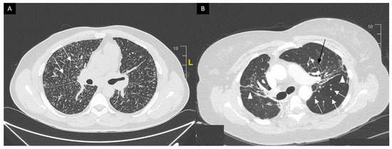 Sarcoidosis: A Clinical Overview from Symptoms to Diagnosis