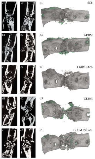 Fibrous Demineralized Bone Matrix (DBM) Improves Bone Marrow ...