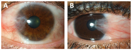 Pterygium—The Good, the Bad, and the Ugly
