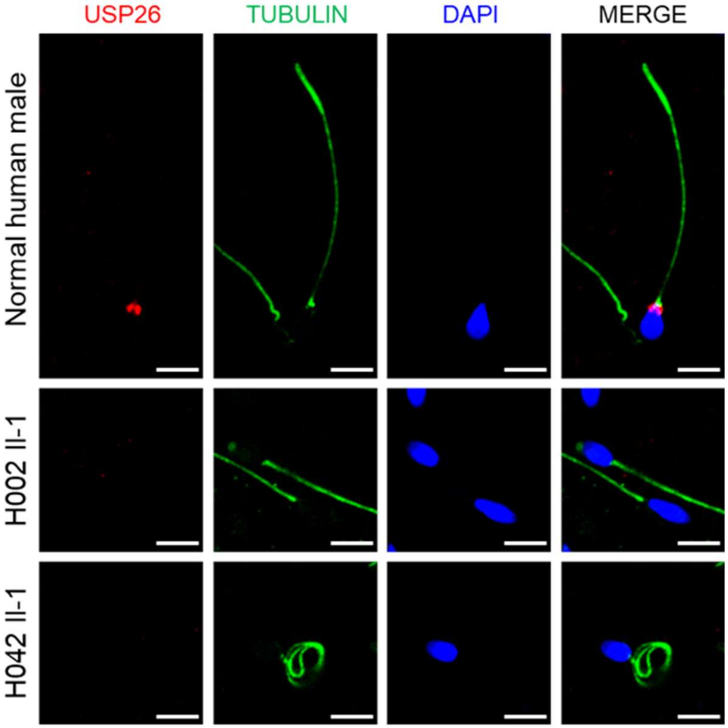 Novel Mutations in X-Linked, USP26-Induced Asthenoteratozoospermia and ...