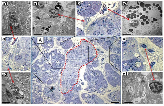Mast Cells and the Pancreas in Human Type 1 and Type 2 Diabetes