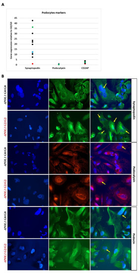 Novel Human Podocyte Cell Model Carrying G2/G2 APOL1 High-Risk Genotype
