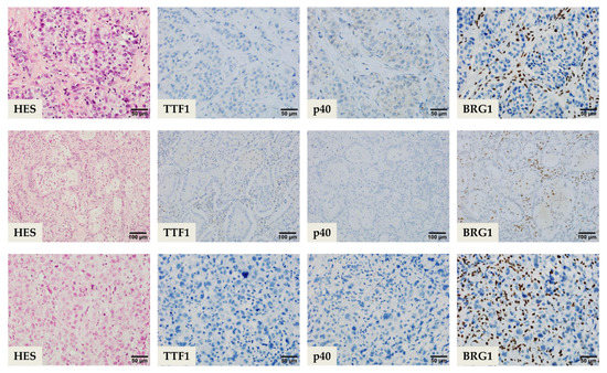 Perspectives and Issues in the Assessment of SMARCA4 Deficiency in the ...