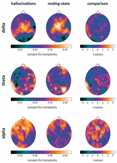 High-Density EEG in a Charles Bonnet Syndrome Patient during and ...