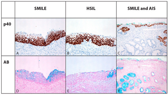 Stratified Mucin-Producing Intraepithelial Lesion (SMILE) of the ...