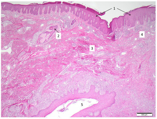 Hidradenitis Suppurativa: Where We Are and Where We Are Going