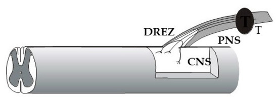 Dorsal Root Injury—A Model for Exploring Pathophysiology and ...