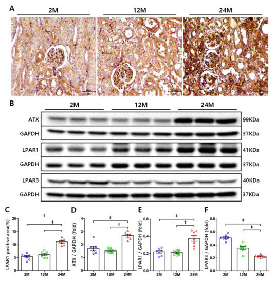 Role of Aberrantly Activated Lysophosphatidic Acid Receptor 1 Signaling ...