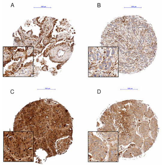Chaperone-Mediated Autophagy Markers LAMP2A and HSPA8 in Advanced Non ...
