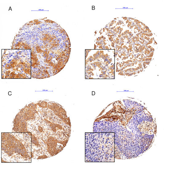 Chaperone-Mediated Autophagy Markers LAMP2A and HSPA8 in Advanced Non ...