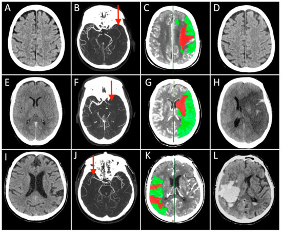 Translational Stroke Research Review: Using the Mouse to Model Human ...