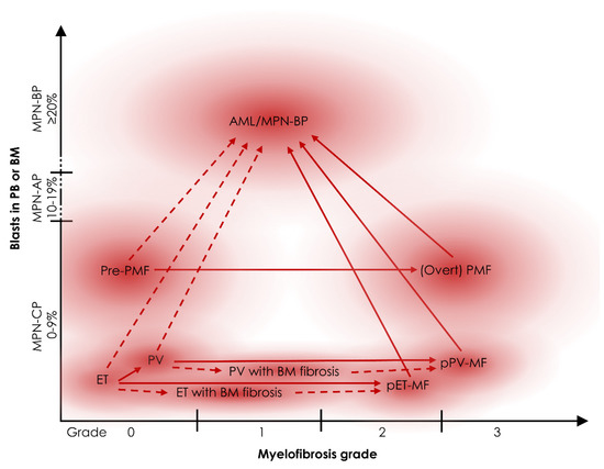 Progression of Myeloproliferative Neoplasms (MPN): Diagnostic and ...