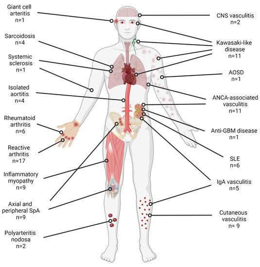 New Onset of Autoimmune Diseases Following COVID-19 Diagnosis